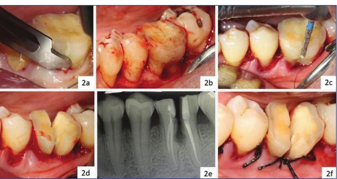 [table/fig-2]: a) crevicular incision; b) full thickness