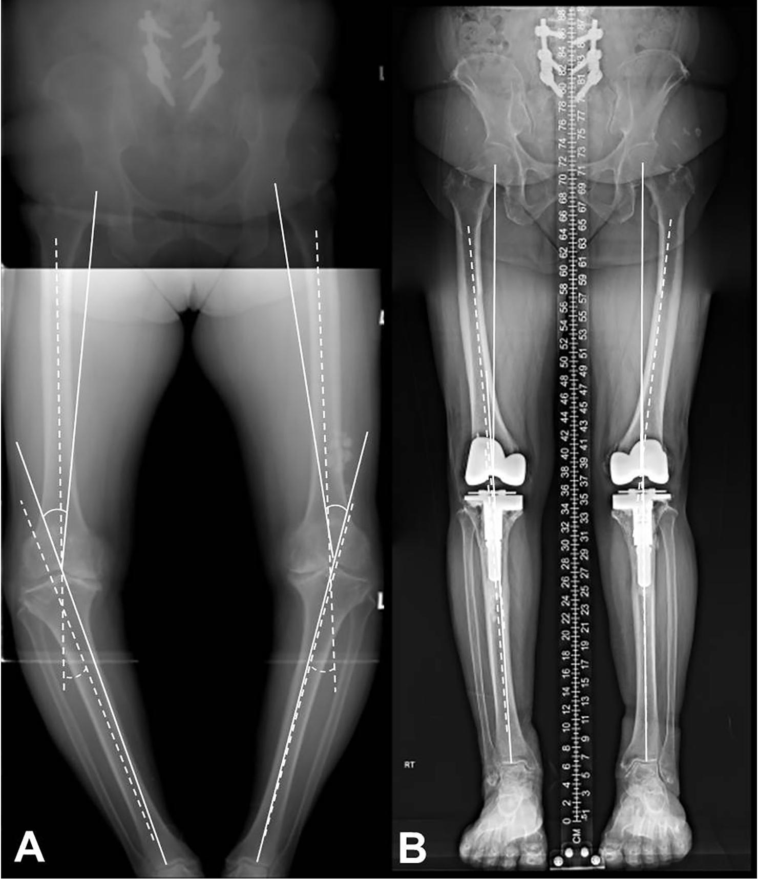 Femorotibial angle (dotted line) and mechanical axis (solid