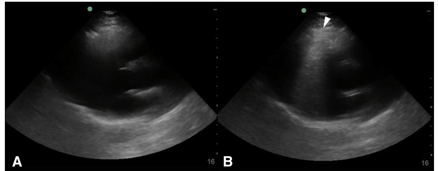Cardiac ultrasound demonstrating (a) easily visualized