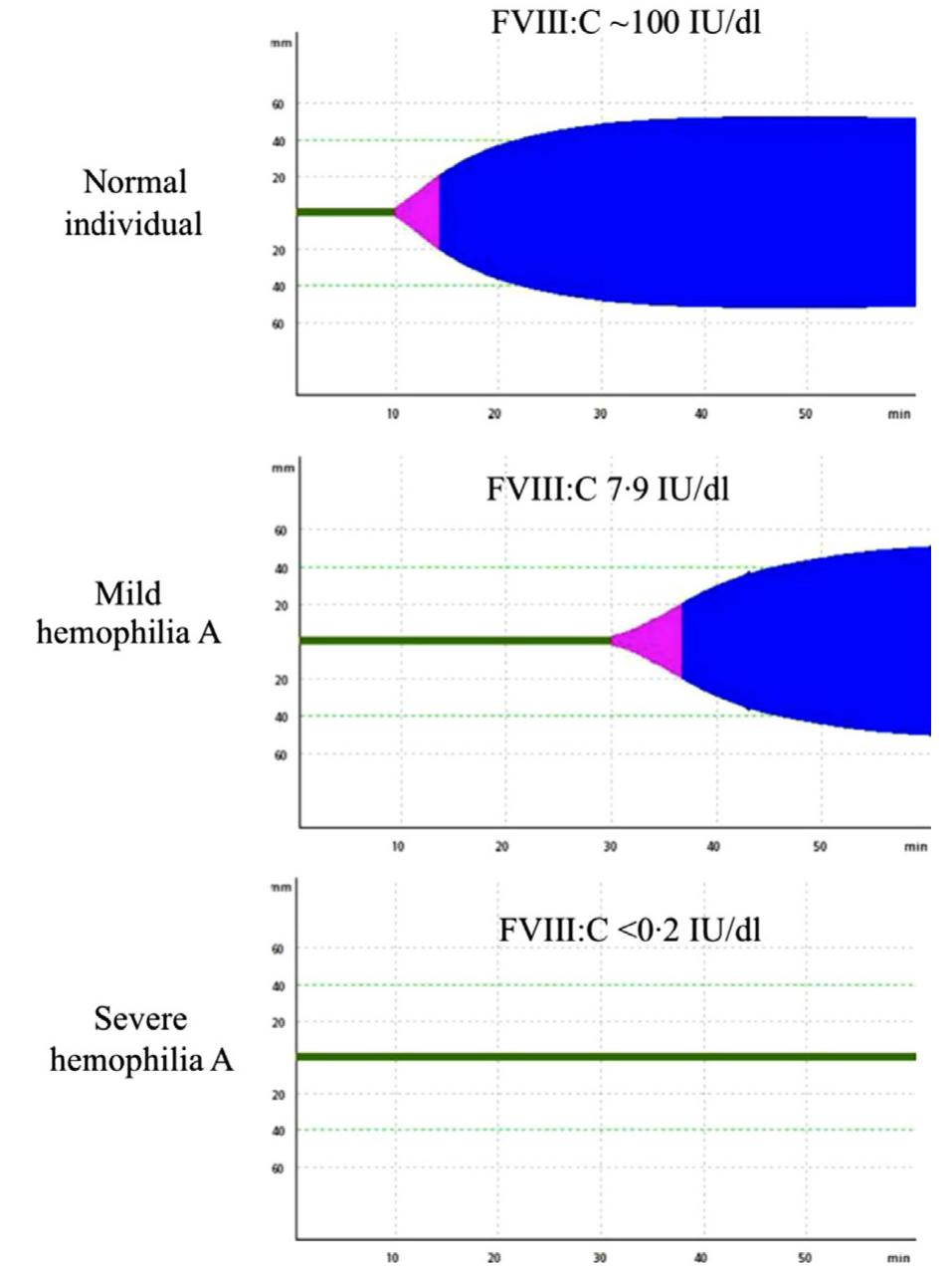 Rotational thromboelastometry patterns in mild and severe
