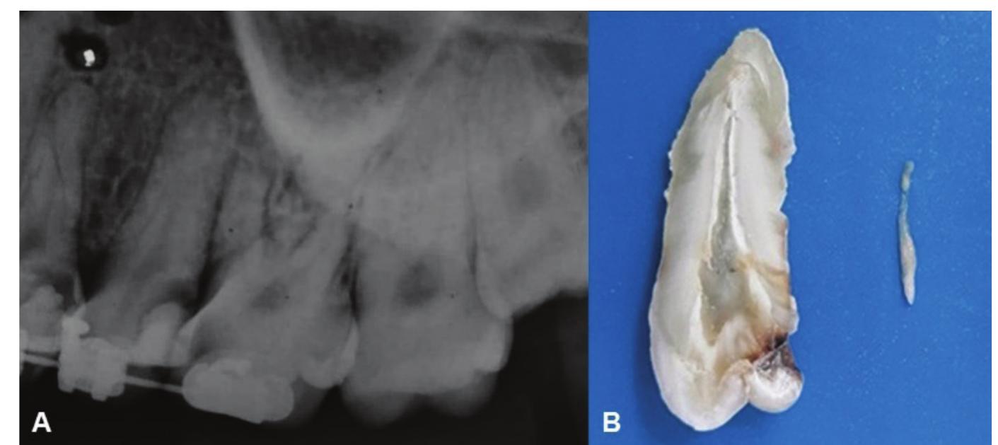 A. periapical radiograph showing an extensive deep carious