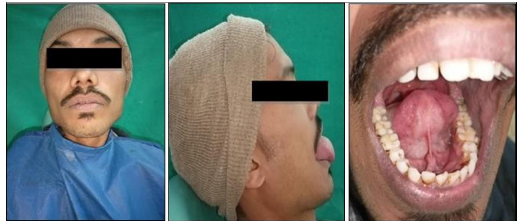 (a) frontal view, (b) lateral view with minimal tongue