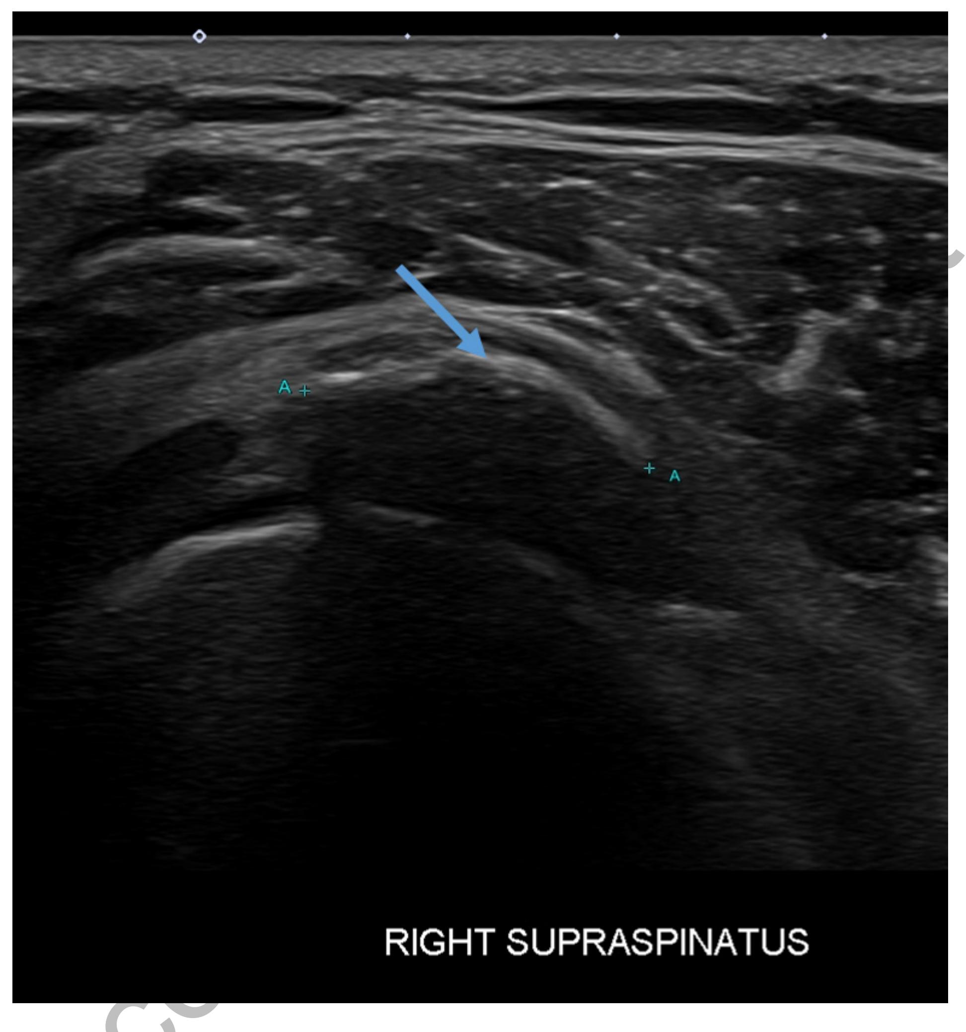 Figure 2 - from Calcific tendinopathy of the rotator cuff: a
