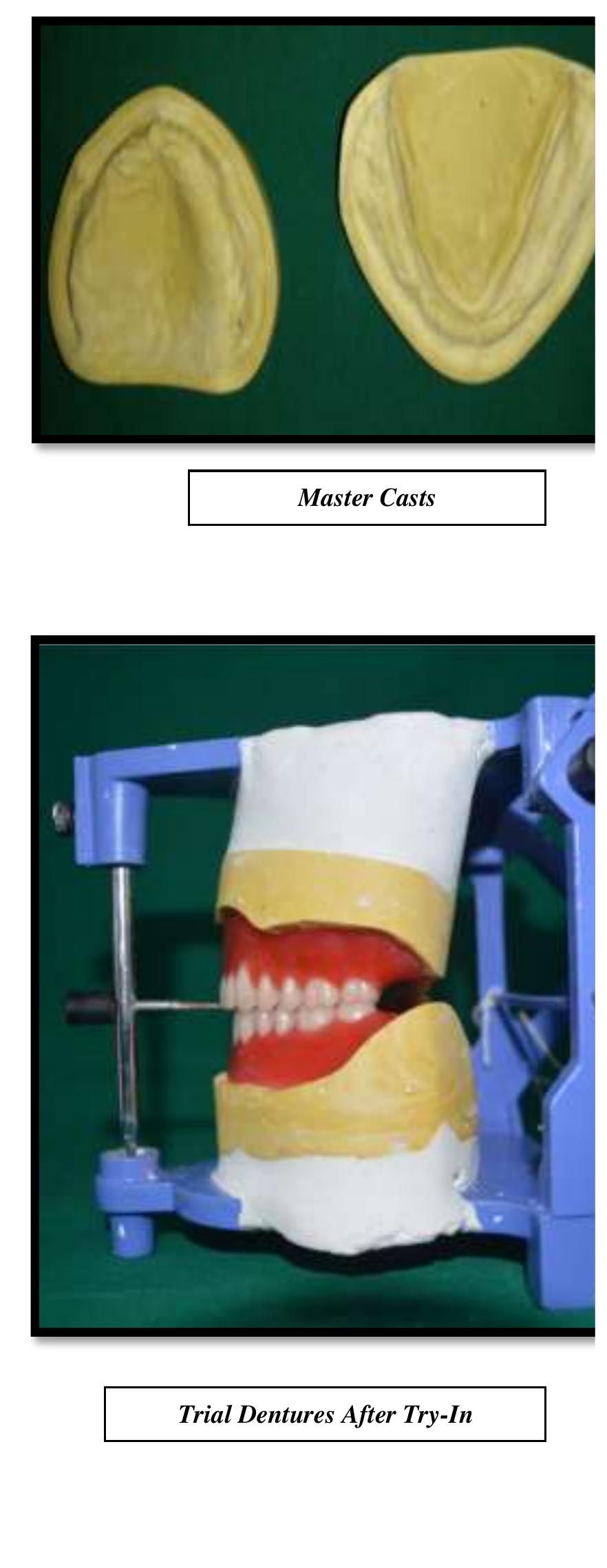 Figure 5 - The Split Mandibular Complete Denture – Technique
