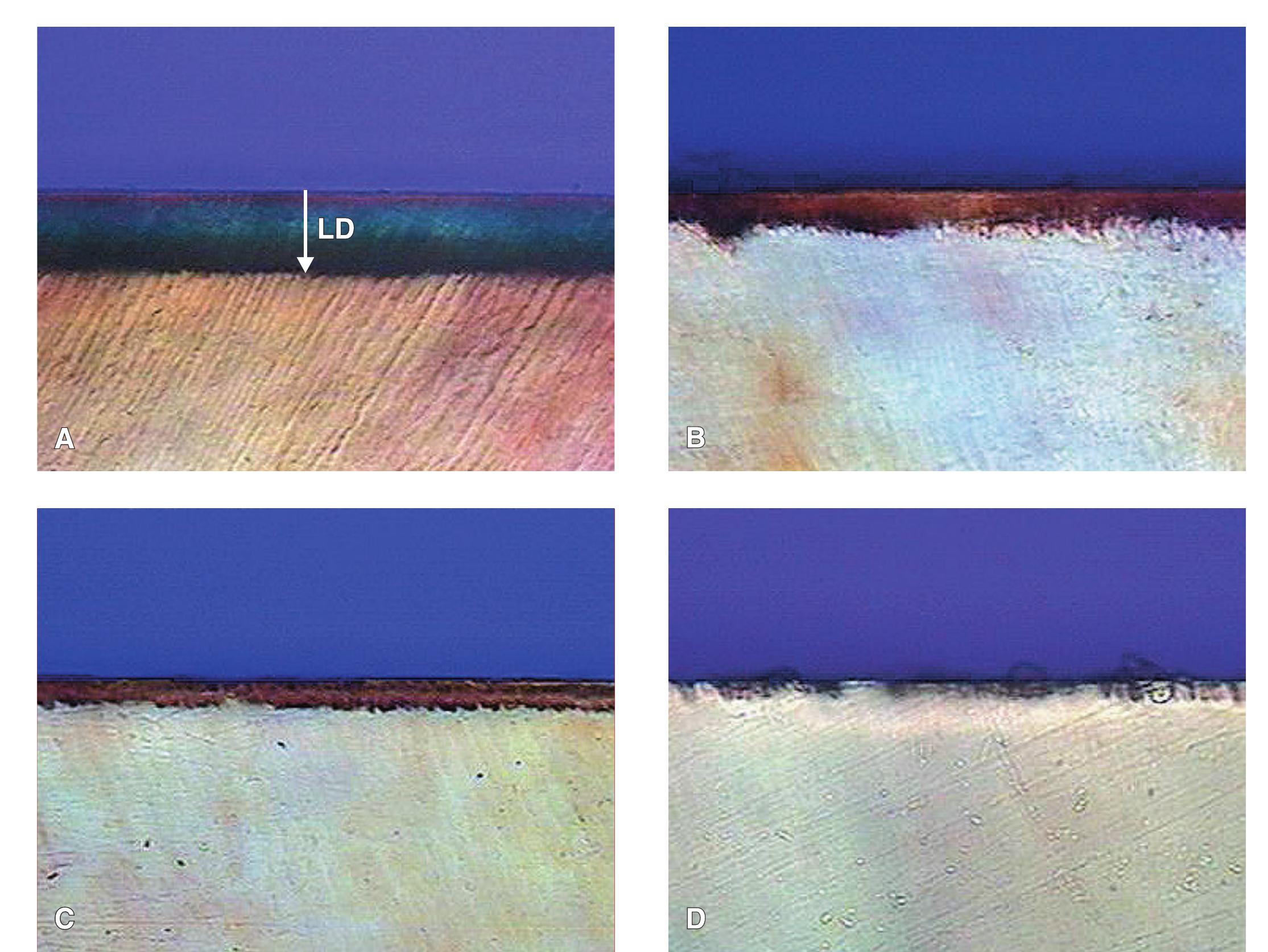 - polarized light microscopy of the caries lesions from the