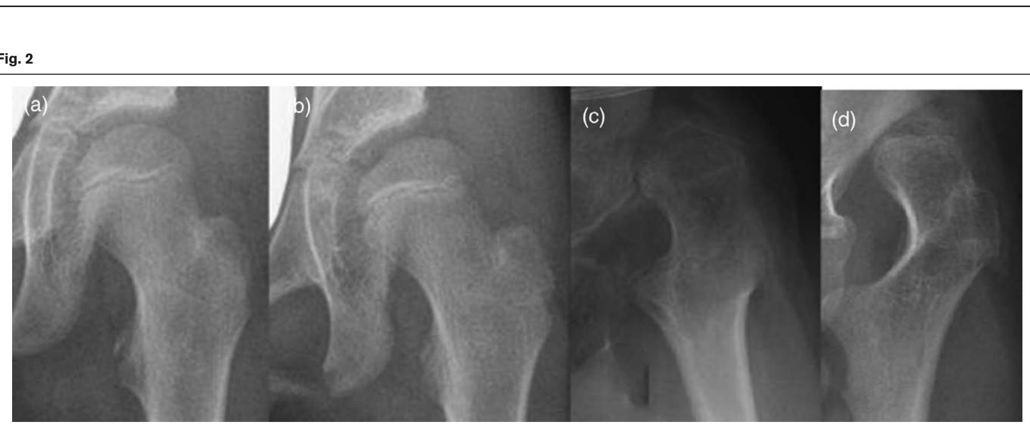 Femoral head shape classification described by rutz et a/.