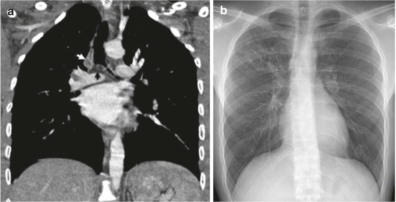 Figure 1 - from Radiological Imaging in Tuberculosis