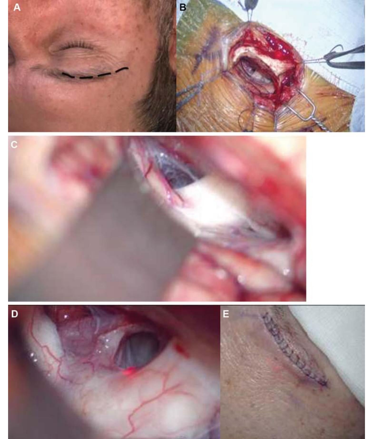 (a) incision for supraorbital craniotomy marked on the right