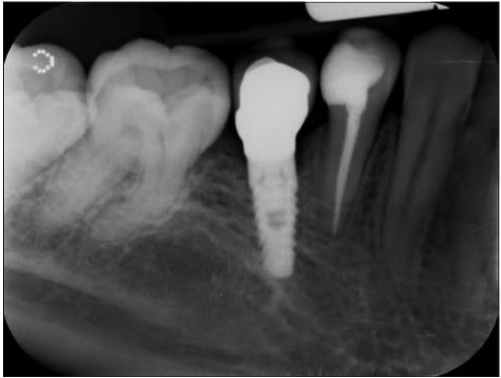 Radiograph showing proper seating of the crown on implant