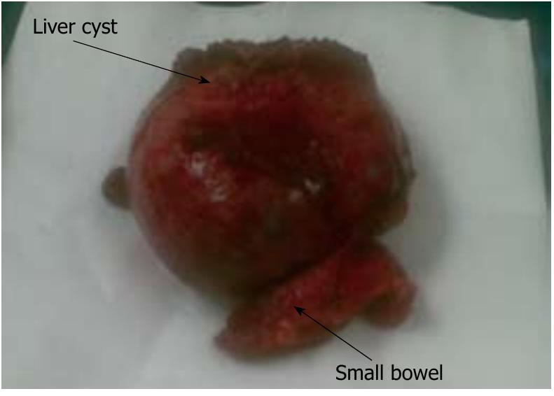 The resected liver cyst of patient 3 with attached small