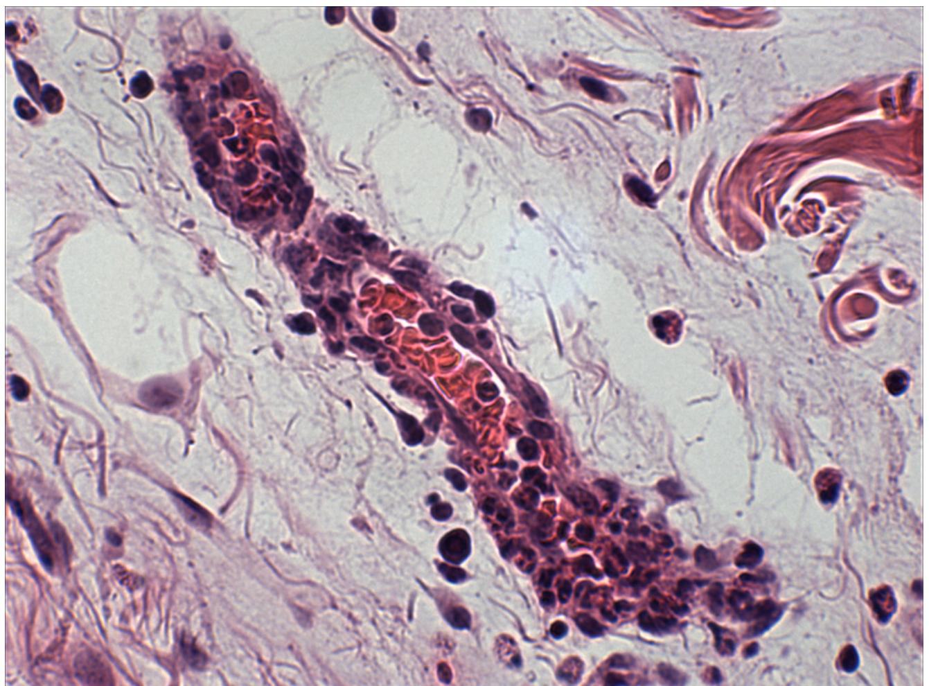 Vasculitis reaction pattern in the skin of a 4-year old