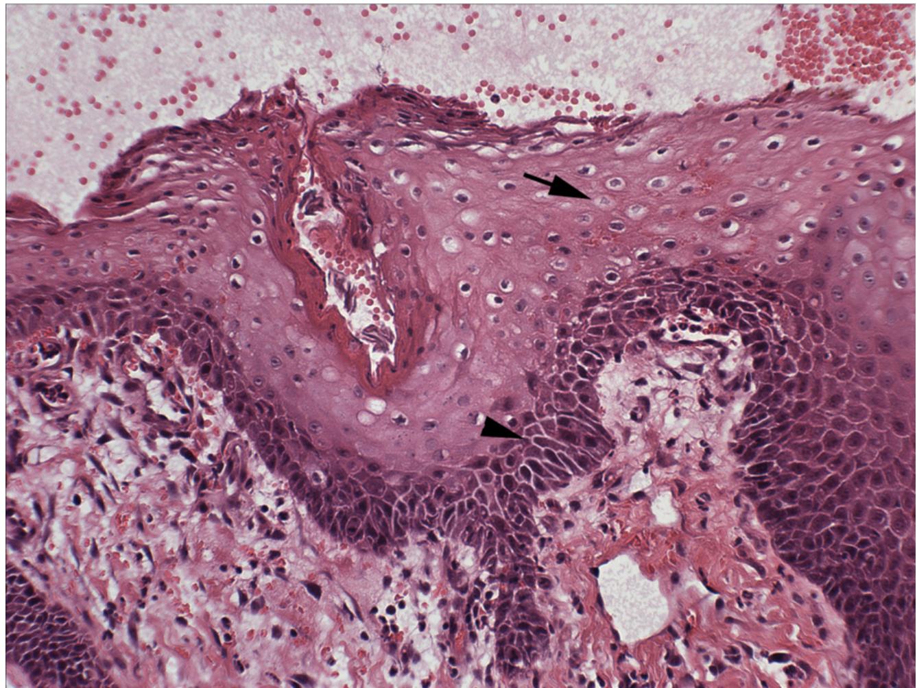 Skin biopsy from the inguinal region of a 12-year old collie