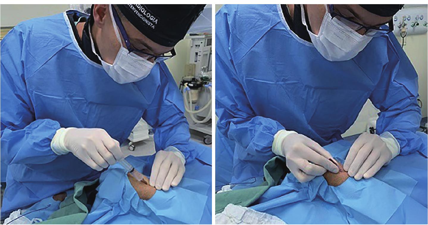 After subcutaneous lidocaine injection, distal radial artery