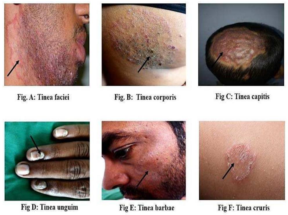 Clinical pictures of dermatophytosis infection. a (tinea