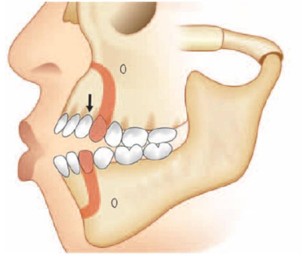 Anterior maxillary and mandibular sub apical osteotomy the