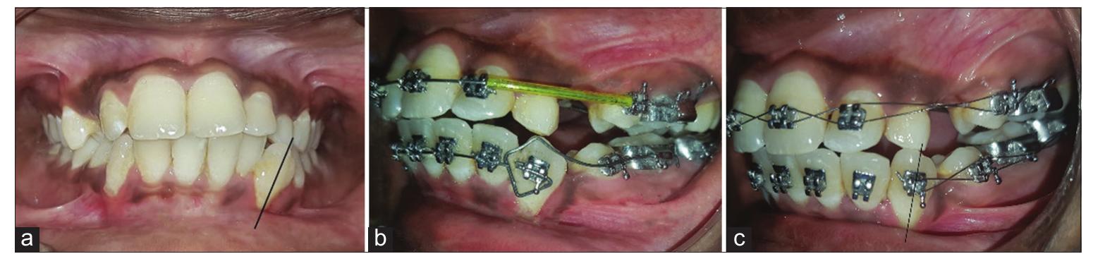 A 21-year-old female patient with angle’s class i