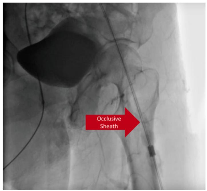 Angiogram of the left iliofemoral artery with large bore