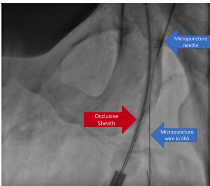 Antegrade access of the left common femoral artery distal to