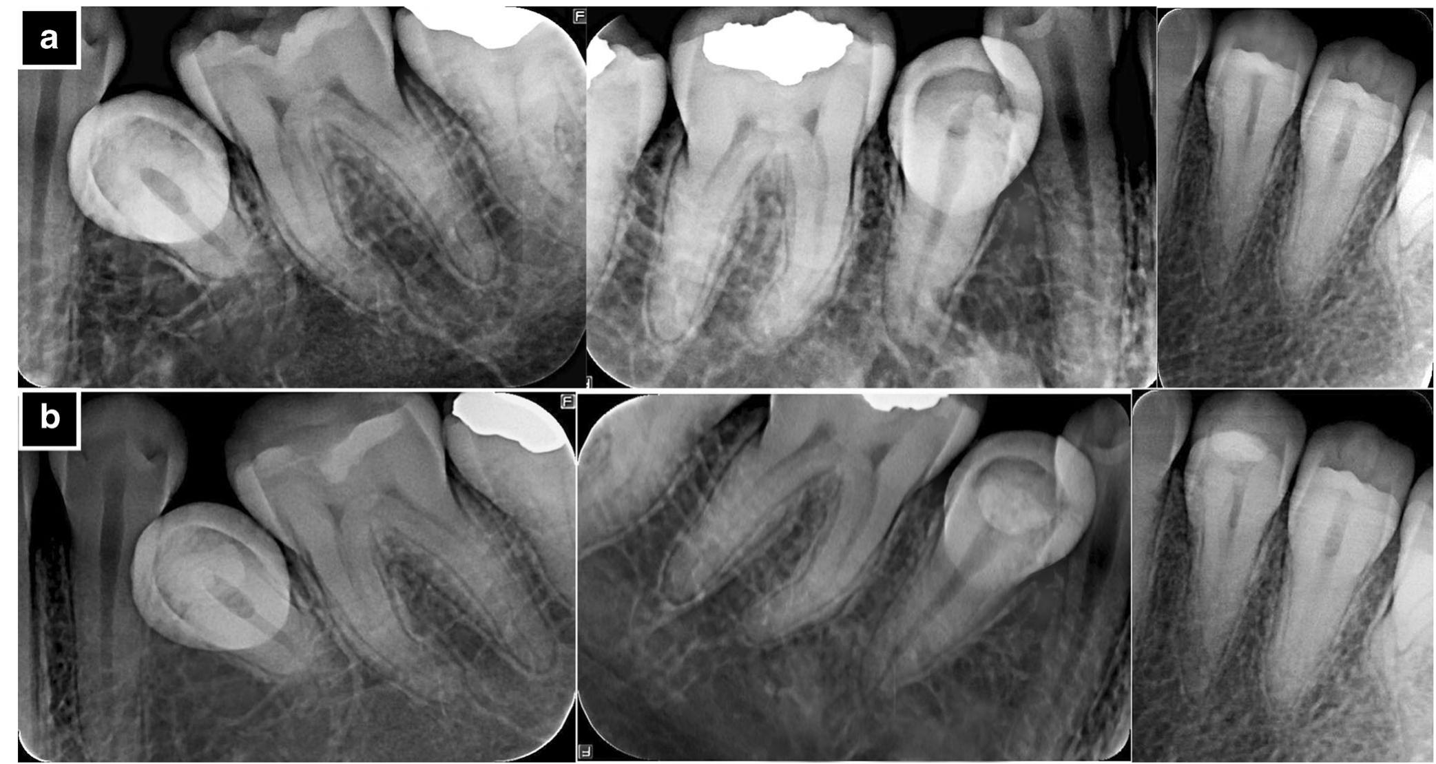 Postoperative periapical radiographs showing no evidence of