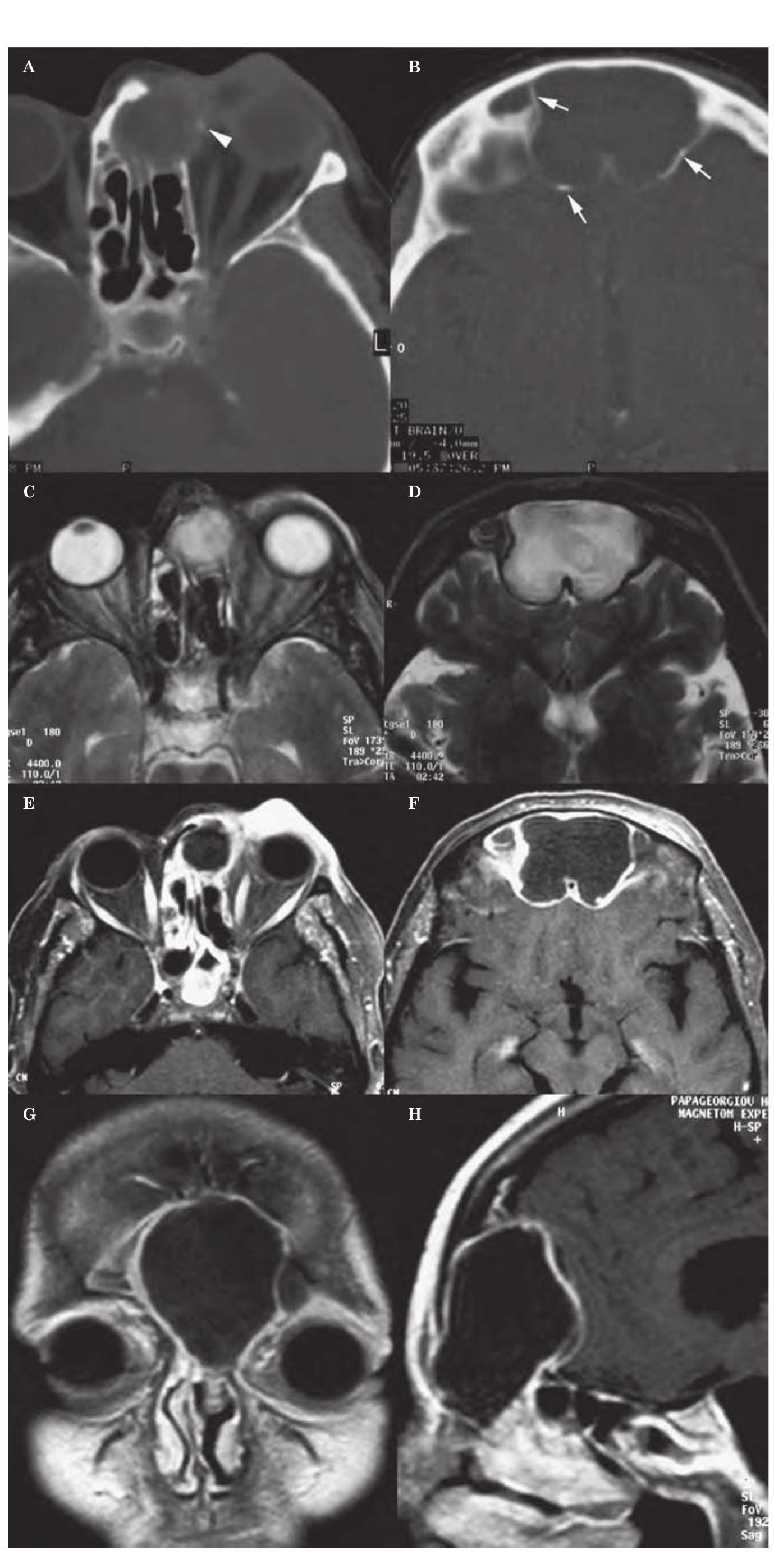 Figure 4 - Frontoethmoidal Mucoceles: CT and MRI Evaluation