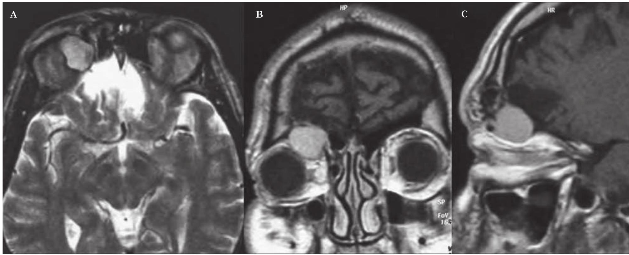 A-c mucocele of the ethmoids of the medial orbital floor