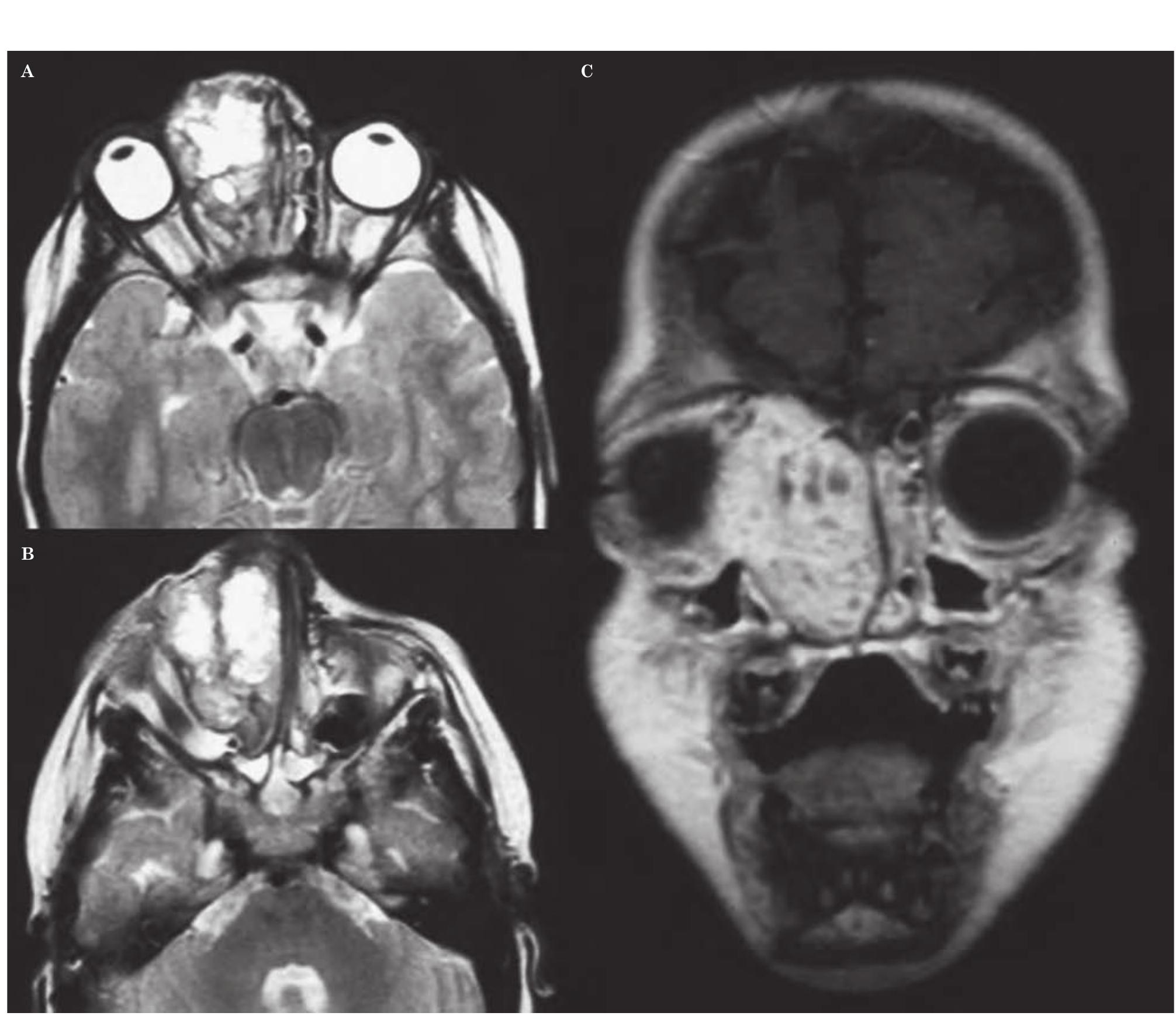 A-c mucocele of the right anterior and posterior ethmoids,