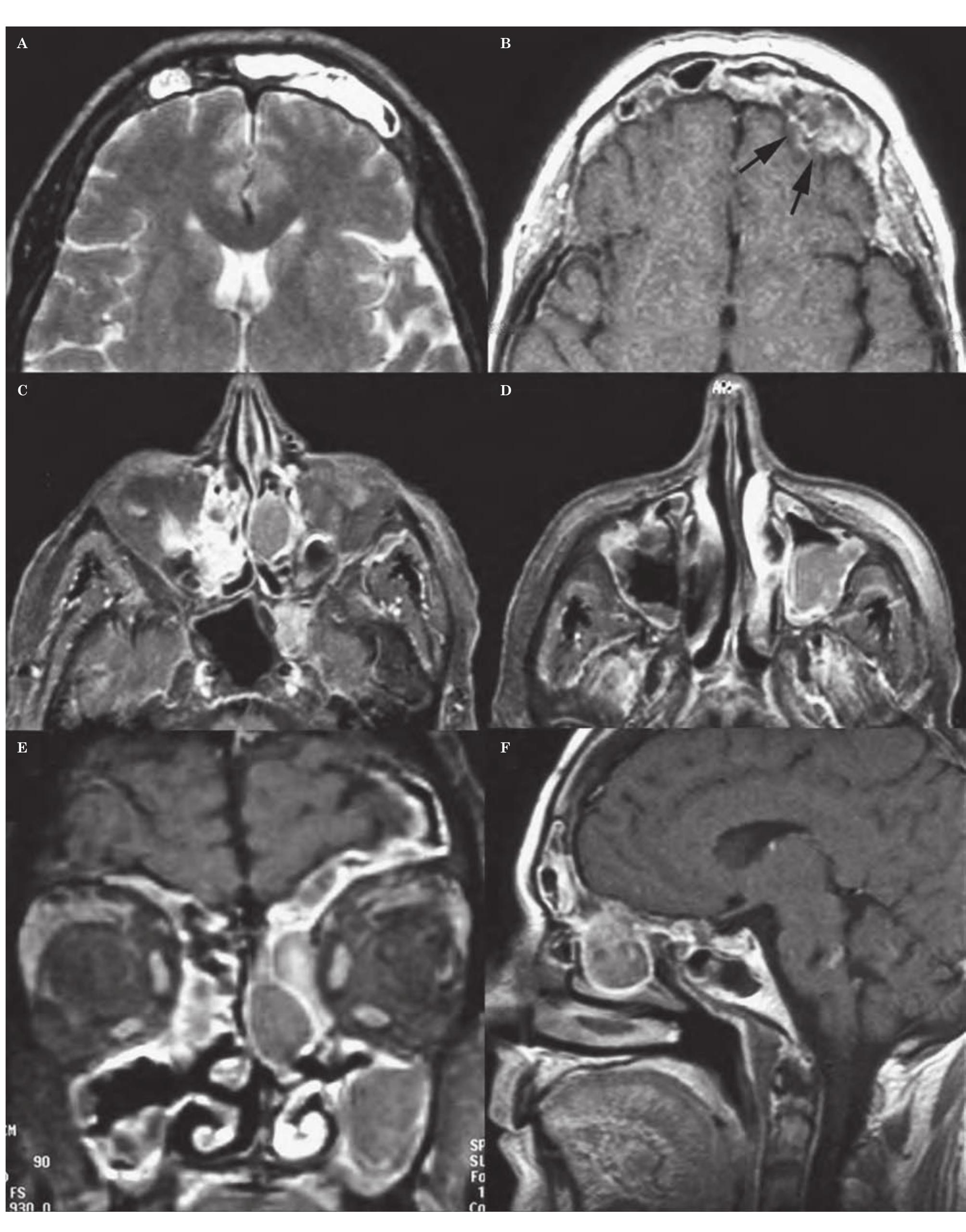 Figure 8 - Frontoethmoidal Mucoceles: CT and MRI Evaluation