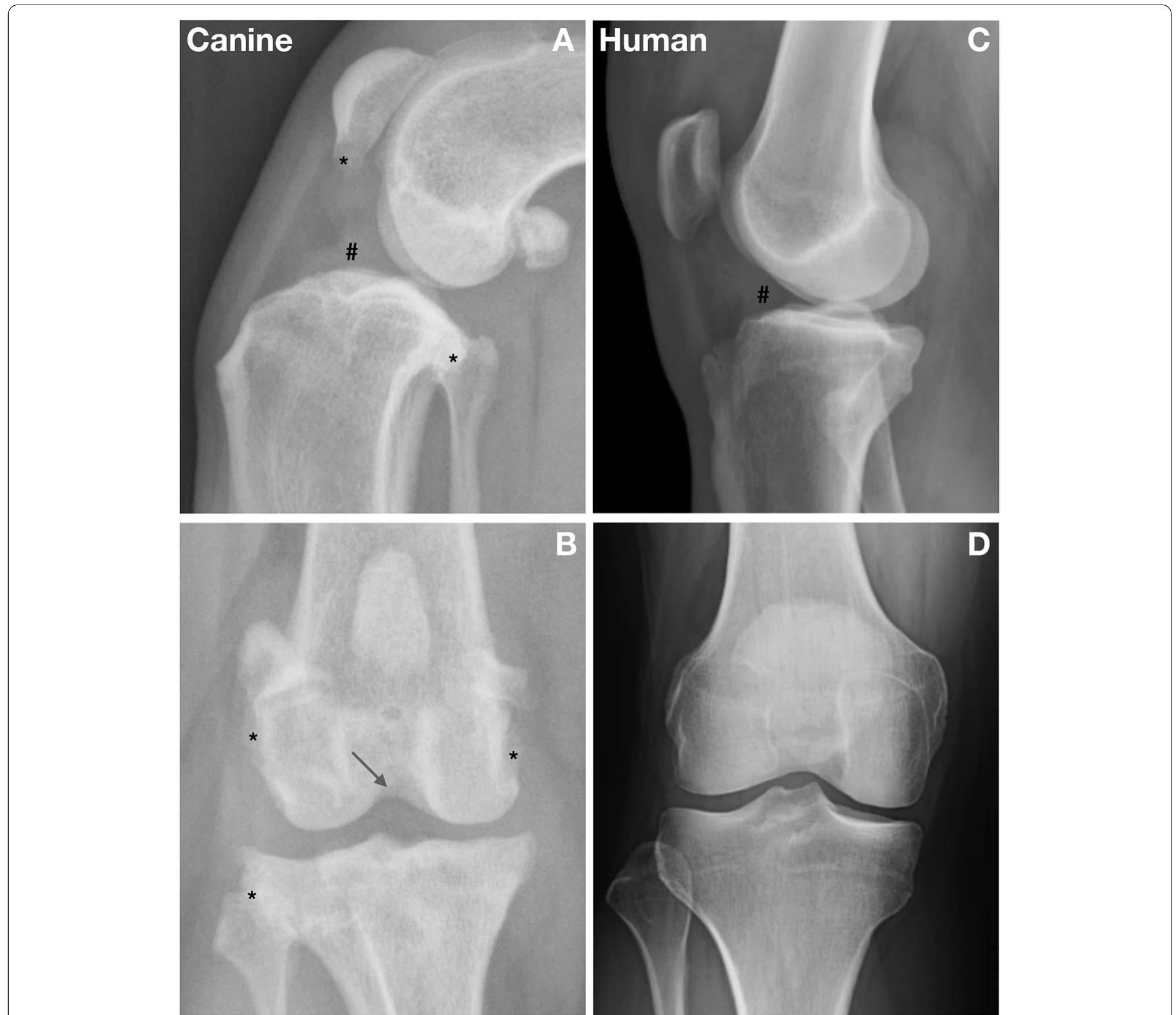 Radiographic features of anterior cruciate ligament (acl)