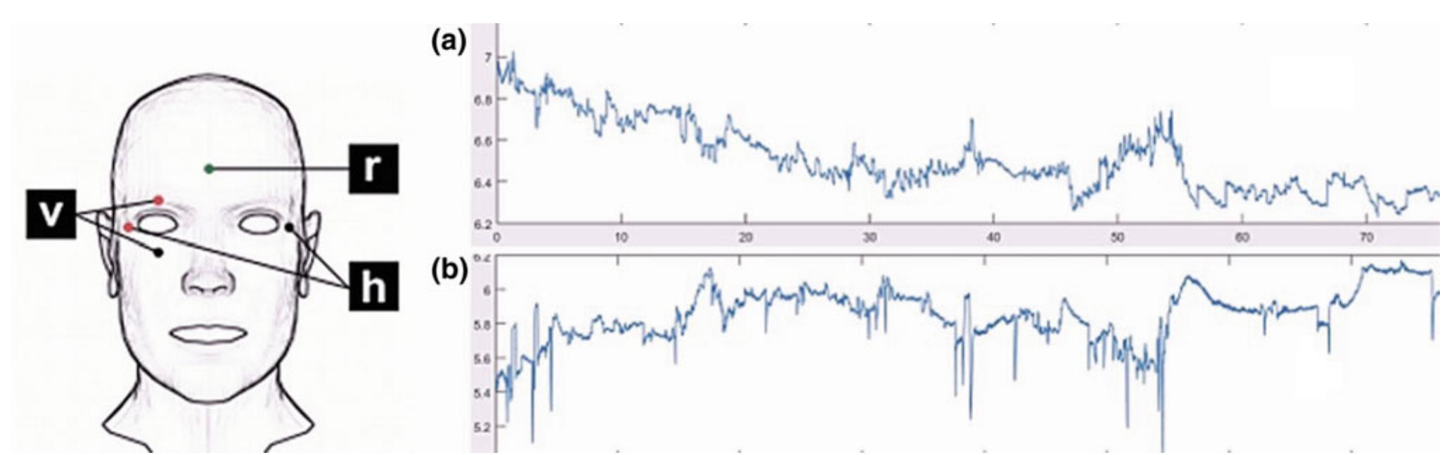 Electrode placement for measuring eog signal; the raw eog