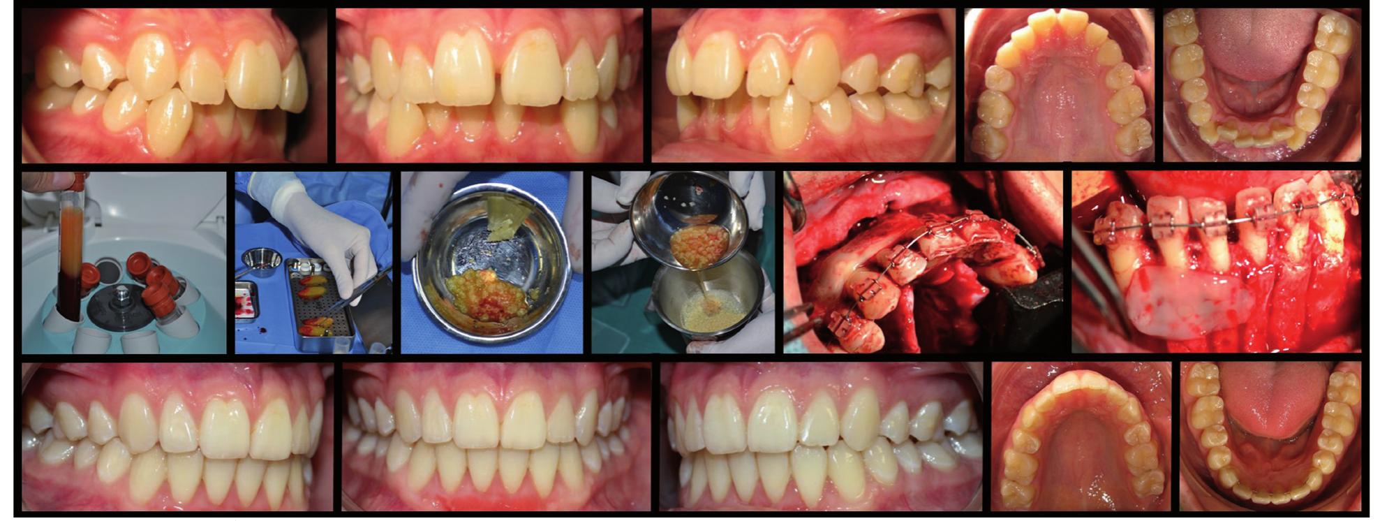 L-prf preparation.
