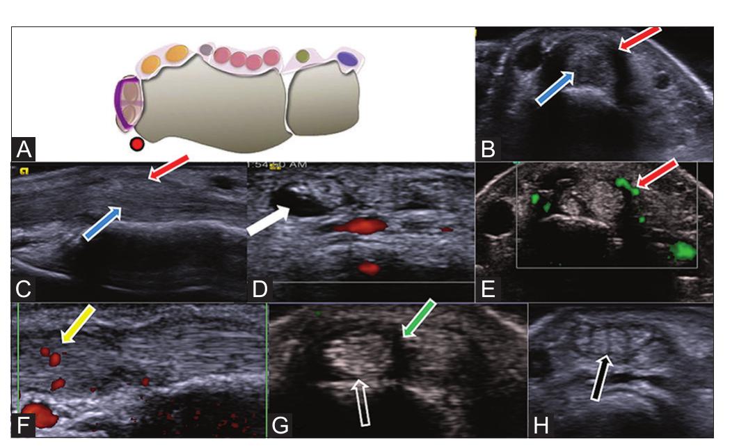 (PDF) Thumb ultrasound: Technique and pathologies