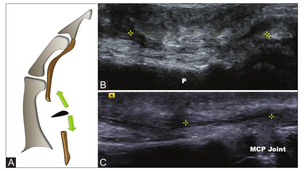 (a-c): flexor pollicis longus tendon tear (a-c). schematic