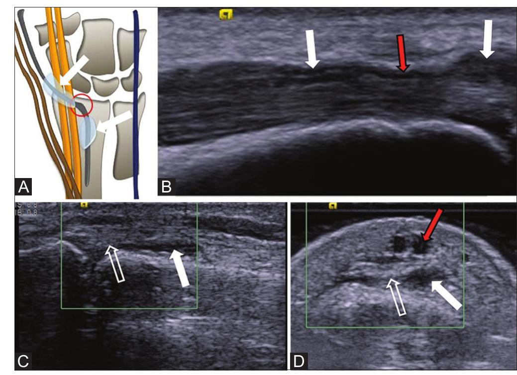 (a-d): epl tenosynovitis (a-d). schematic diagram (a) of the