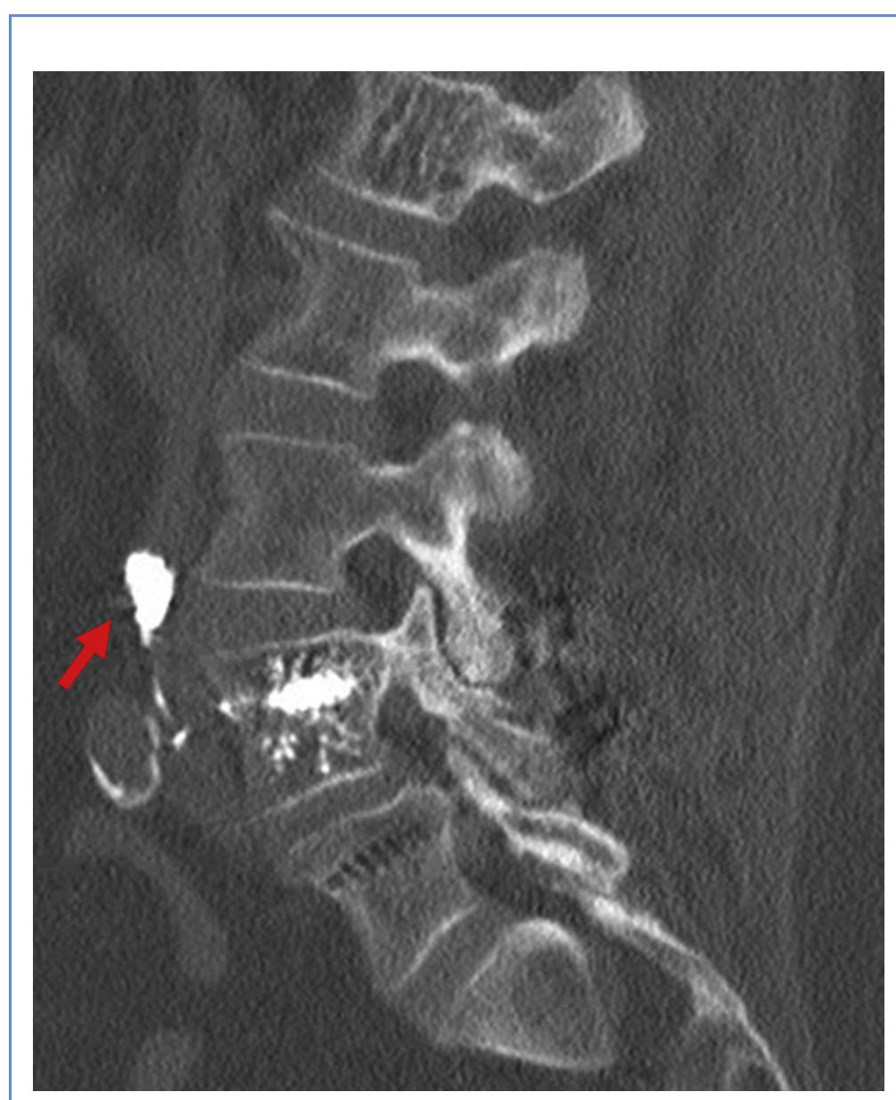 Cement extravasation within the inferior vena cava shown on