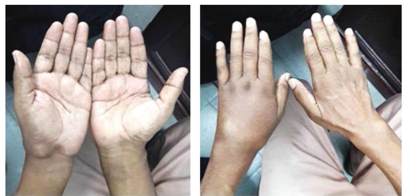 Ficure 1: ventral and dorsal aspects of the wrist showing