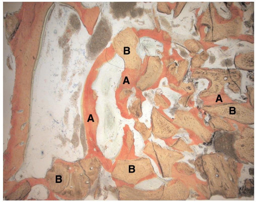 Figure 6 - Effect of Maxillary Sinus Membrane Perforation on
