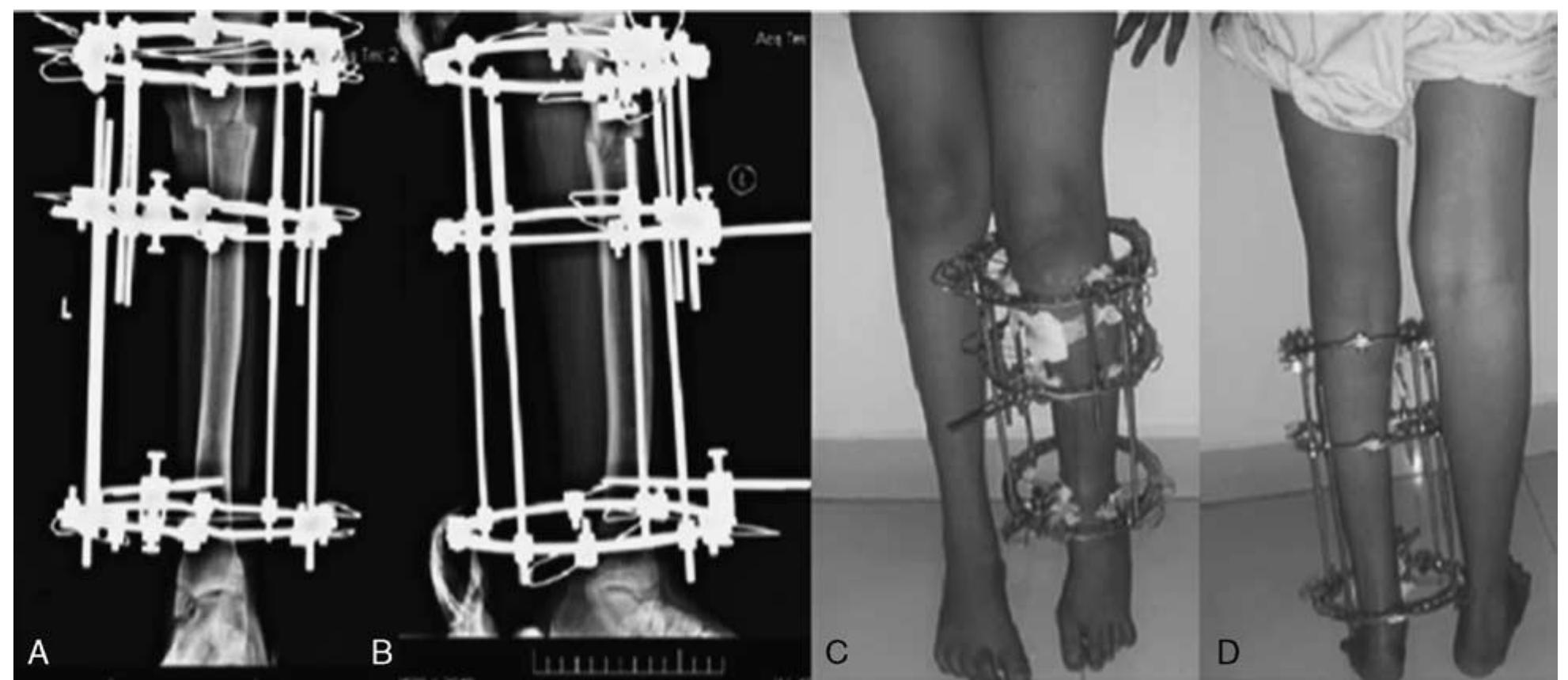 The rotation, genu valgum, and shortening in figure 8 were