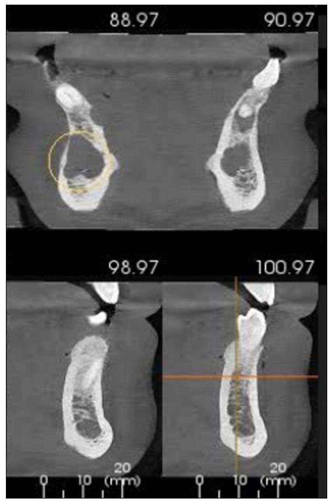 Coronal and sagittal cbct fig 7: axial and sagittal cbct