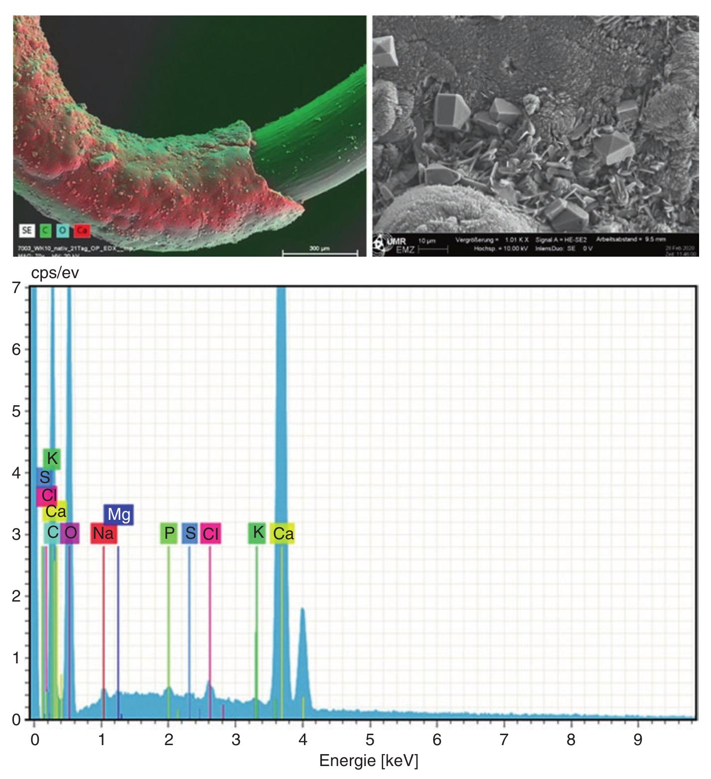 Edx analysis of encrustations on a ureteral stent (rat). top