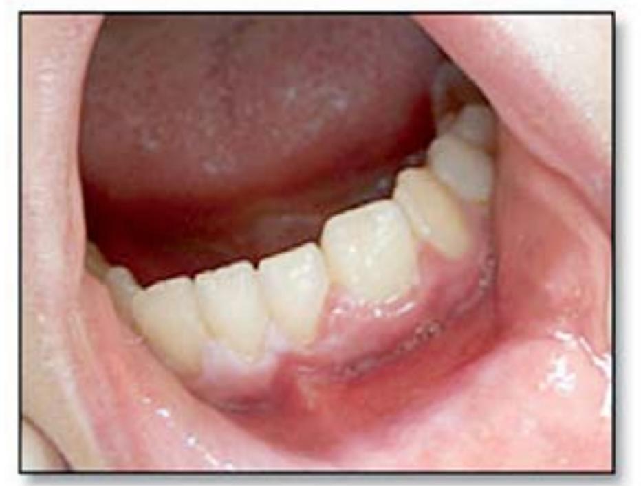 The mandibular anterior teeth with a large crown on the left