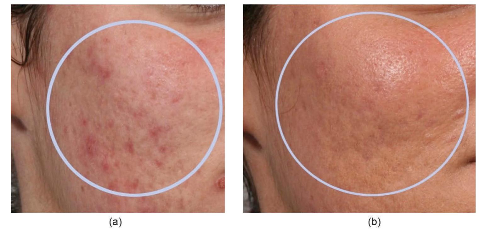 (a) 30-year-old female (skin type ii) with erythematous