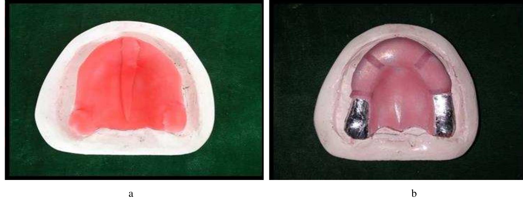 A and b: wax spacer and modified design custom tray was