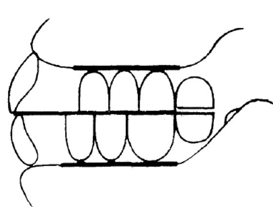 (PDF) Occlusal Concepts in Complete Denture Prosthodontics: A ...