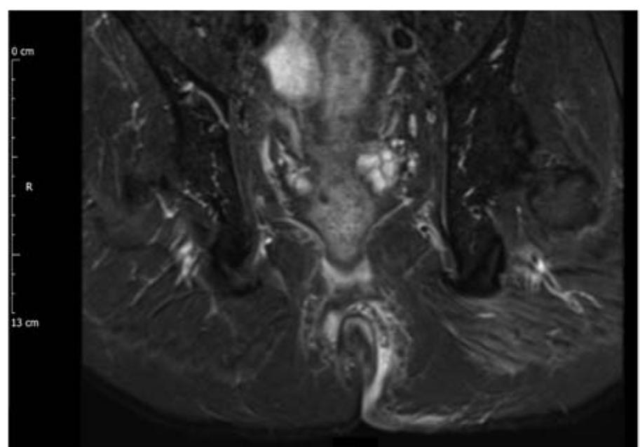 Mri of the pelvis showing a fistula across the anal