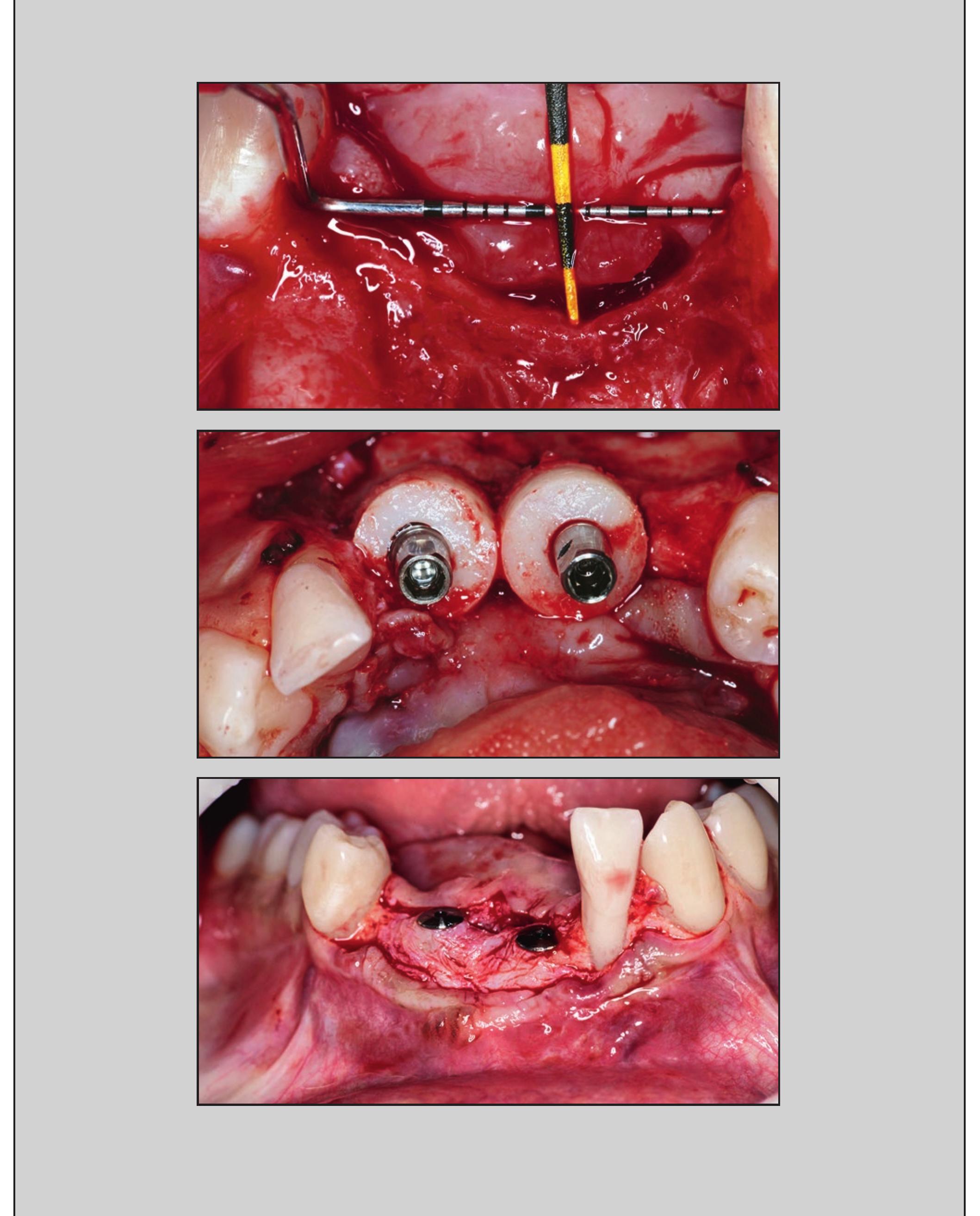 Figure 1 - Bone Ring Technique for the Treatment of Vertical