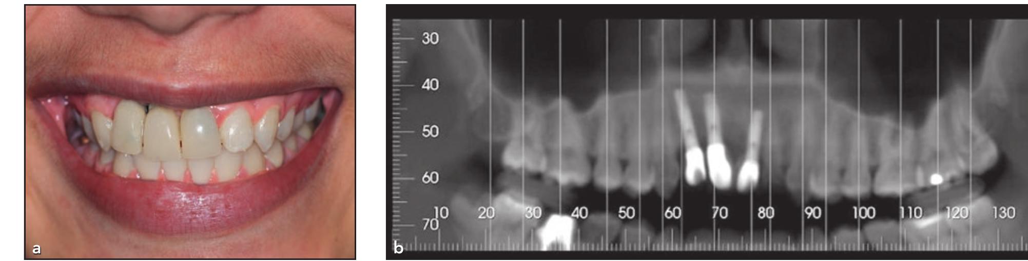 Case 1. (a) initial appearance of the prosthetic crowns with