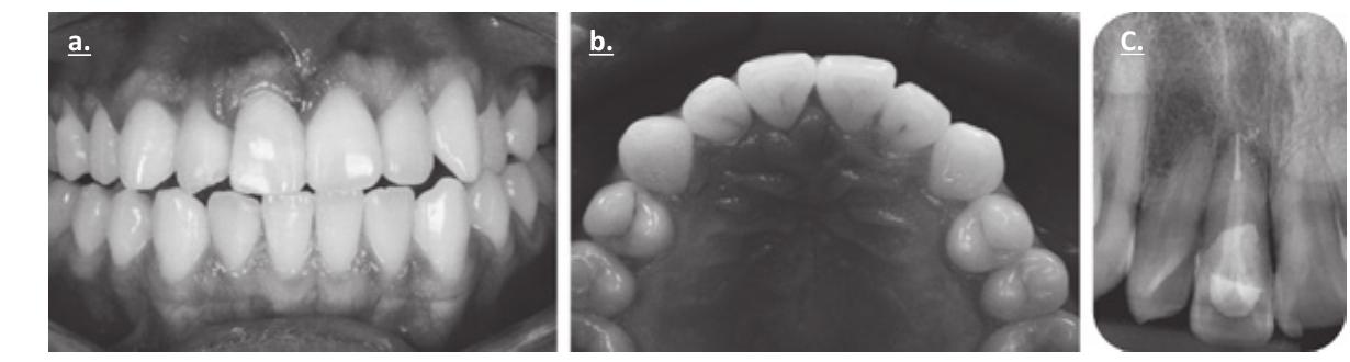 Ten months-follow up. a: buccal view, b: lingual view, c: