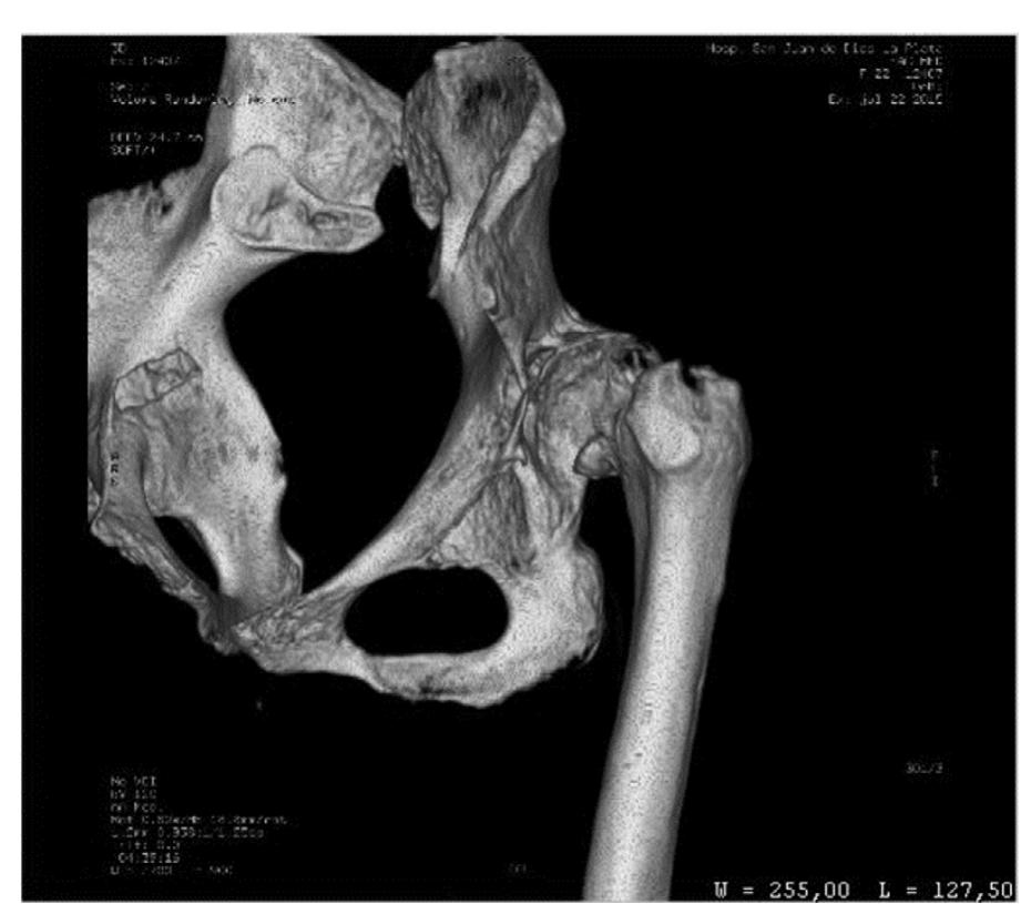 Ct 3d reconstruction of left femoral joint with false