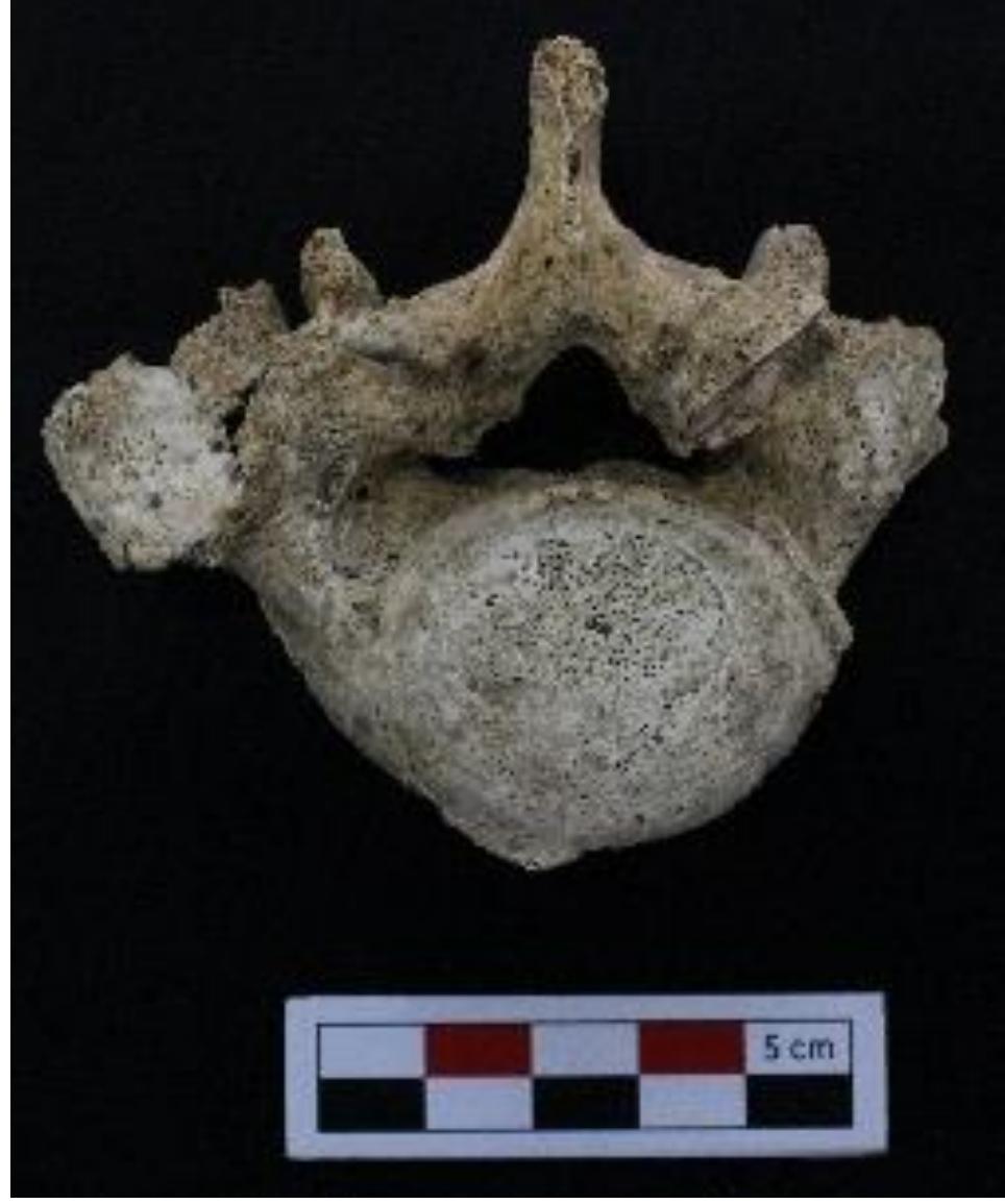 Costa and vertebral fusion figure 13. transverse processes