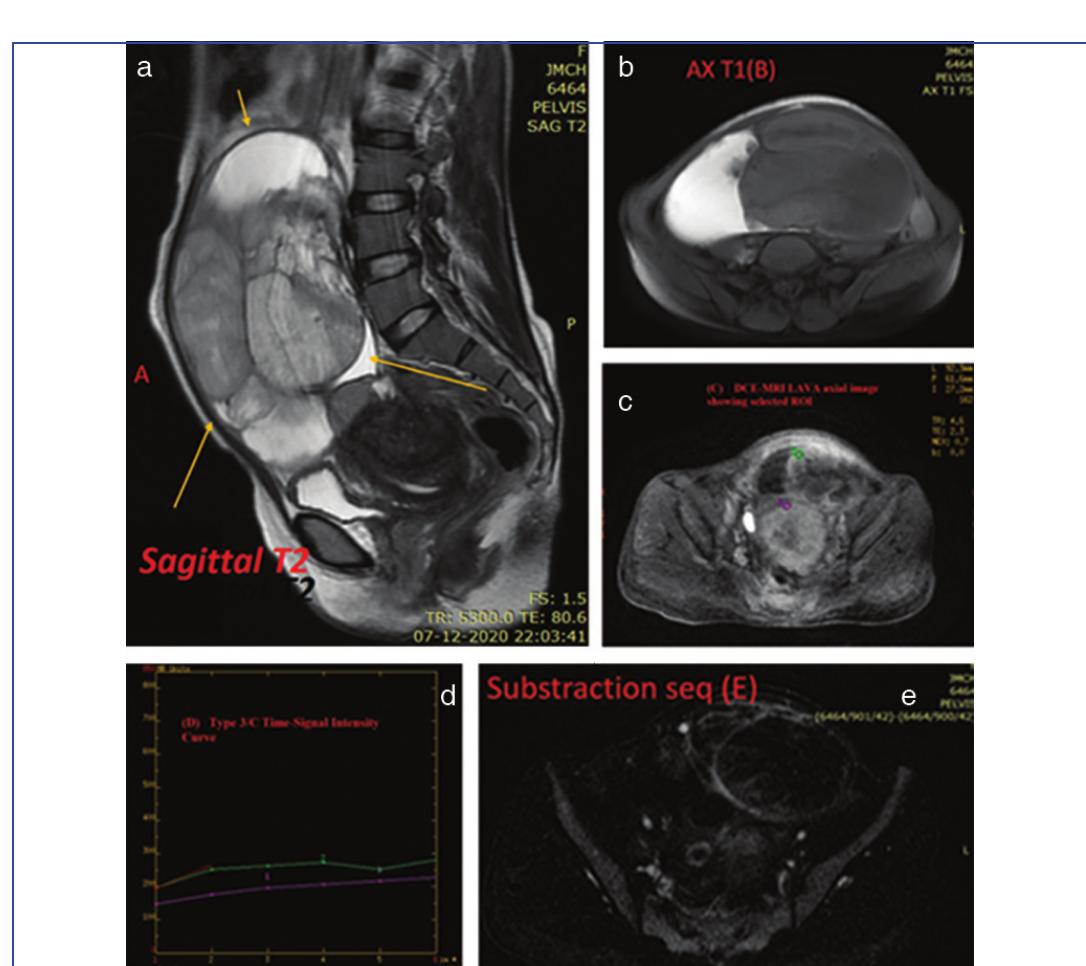 [table/fig-8]: mri images with o-rads mri interpretations of